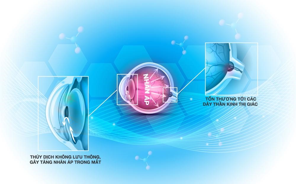 Điều trị glôcôm dưới góc nhìn của chuyên gia