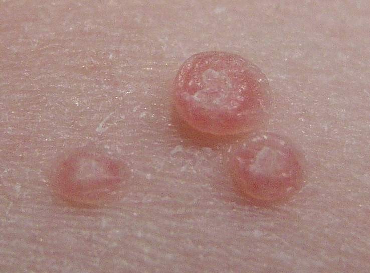 Bệnh u mềm lây có nguy hiểm và điều trị như thế nào?