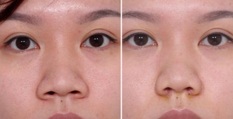 5 yếu tố giúp phân biệt cuộn cánh mũi và cắt cánh mũi