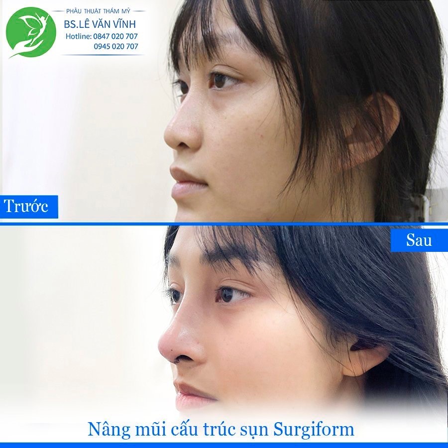 Nâng mũi sụn Surgiform đẹp với bác sĩ giỏi