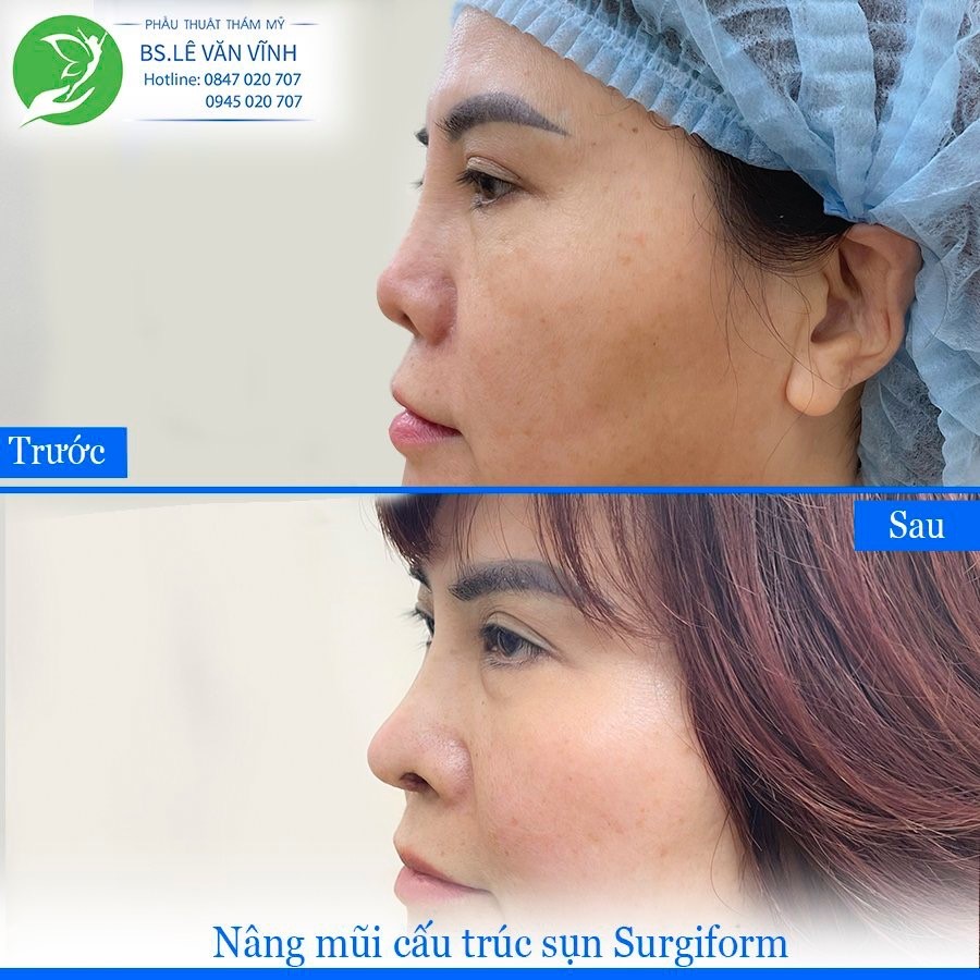 Nâng mũi sụn Surgiform đẹp với bác sĩ giỏi