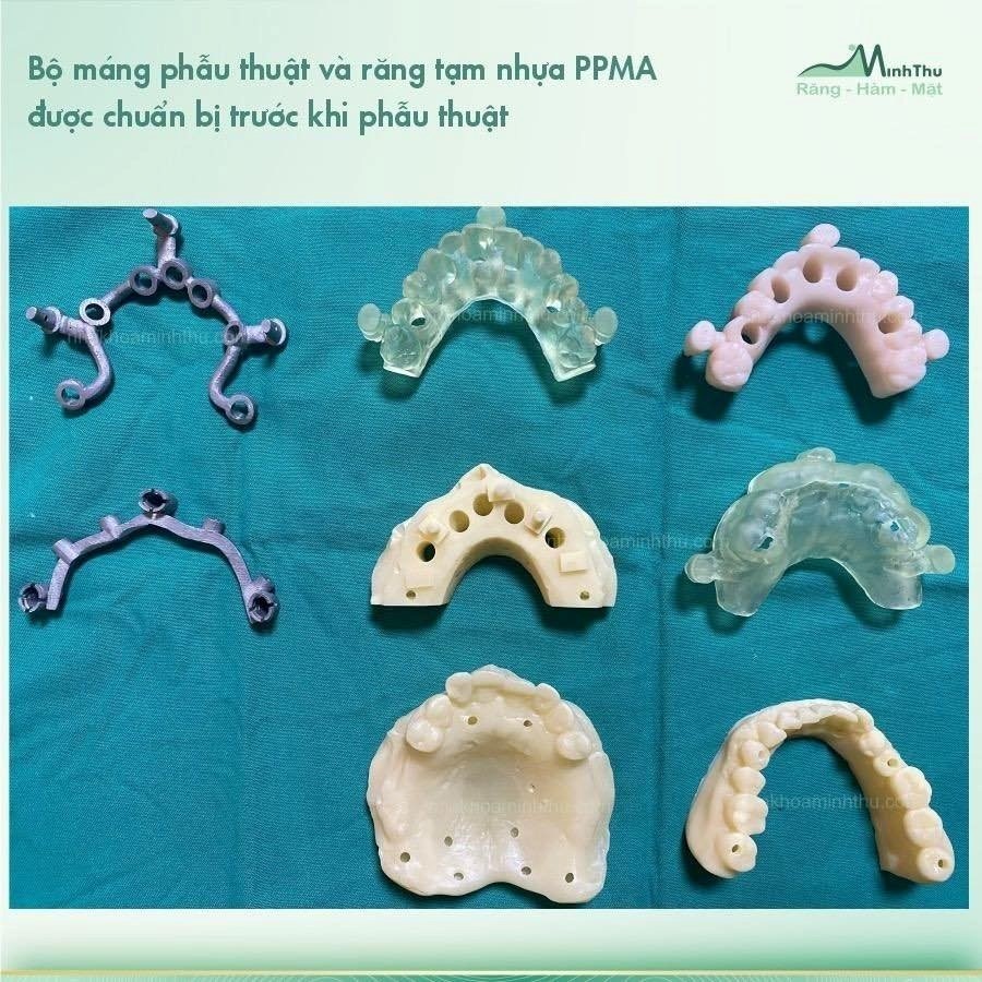 Tại sao cần dùng máng hướng dẫn phẫu thuật Implant trong các ca toàn hàm?