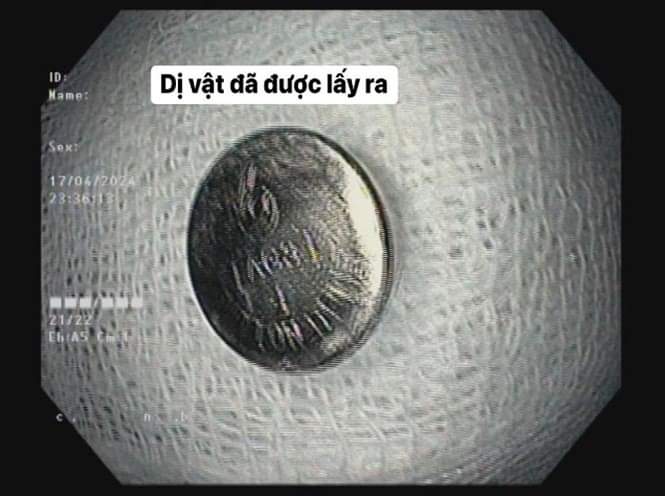 Hải Phòng: Bé 5 tuổi nuốt phải pin cúc