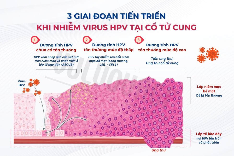 Nhiễm HPV ở cổ tử cung: cách nào giúp cơ thể đẩy nhanh khả năng tự đào thải HPV? - HPV Việt Nam