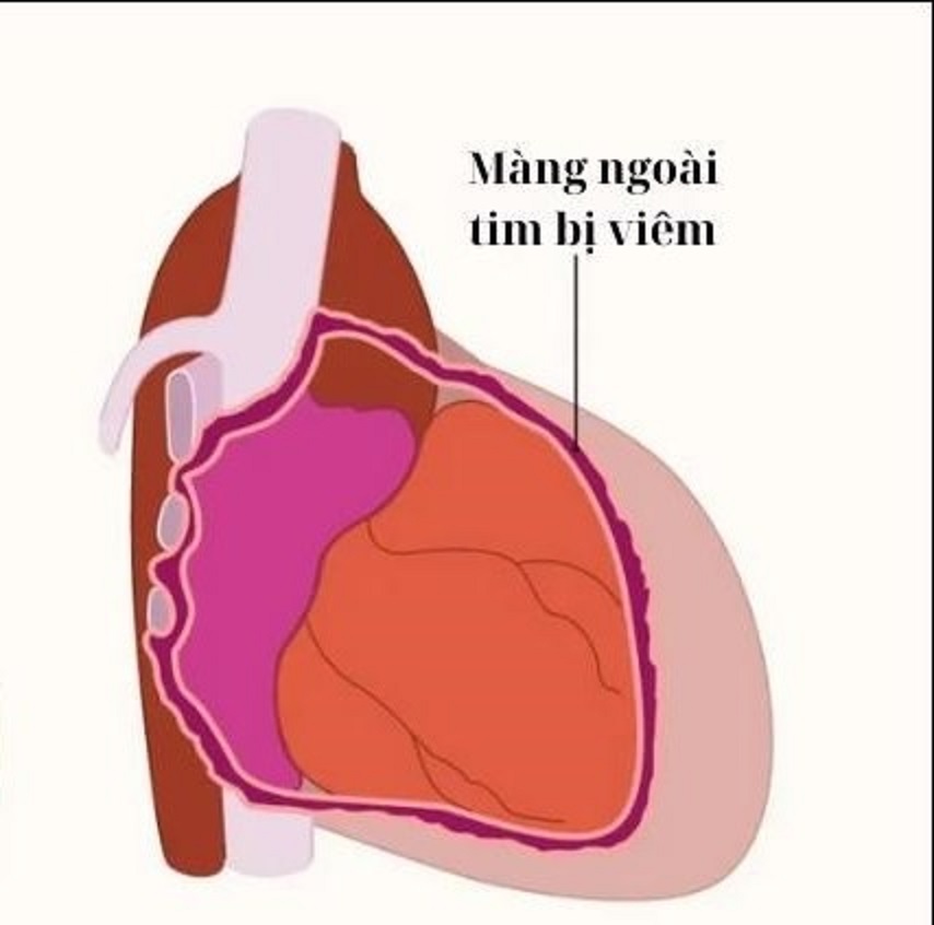 Thuốc và phương pháp điều trị viêm màng ngoài tim