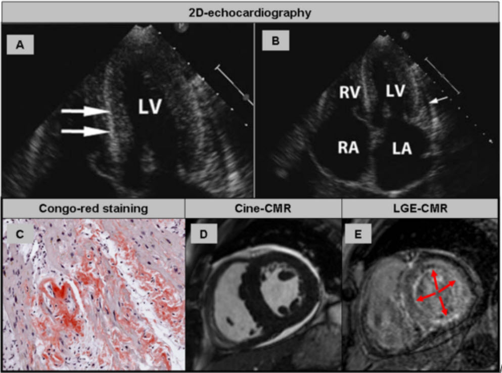 Người cao tuổi khó thở, mệt mỏi: Coi chừng bệnh amyloid tim | TRUNG TÂM ...