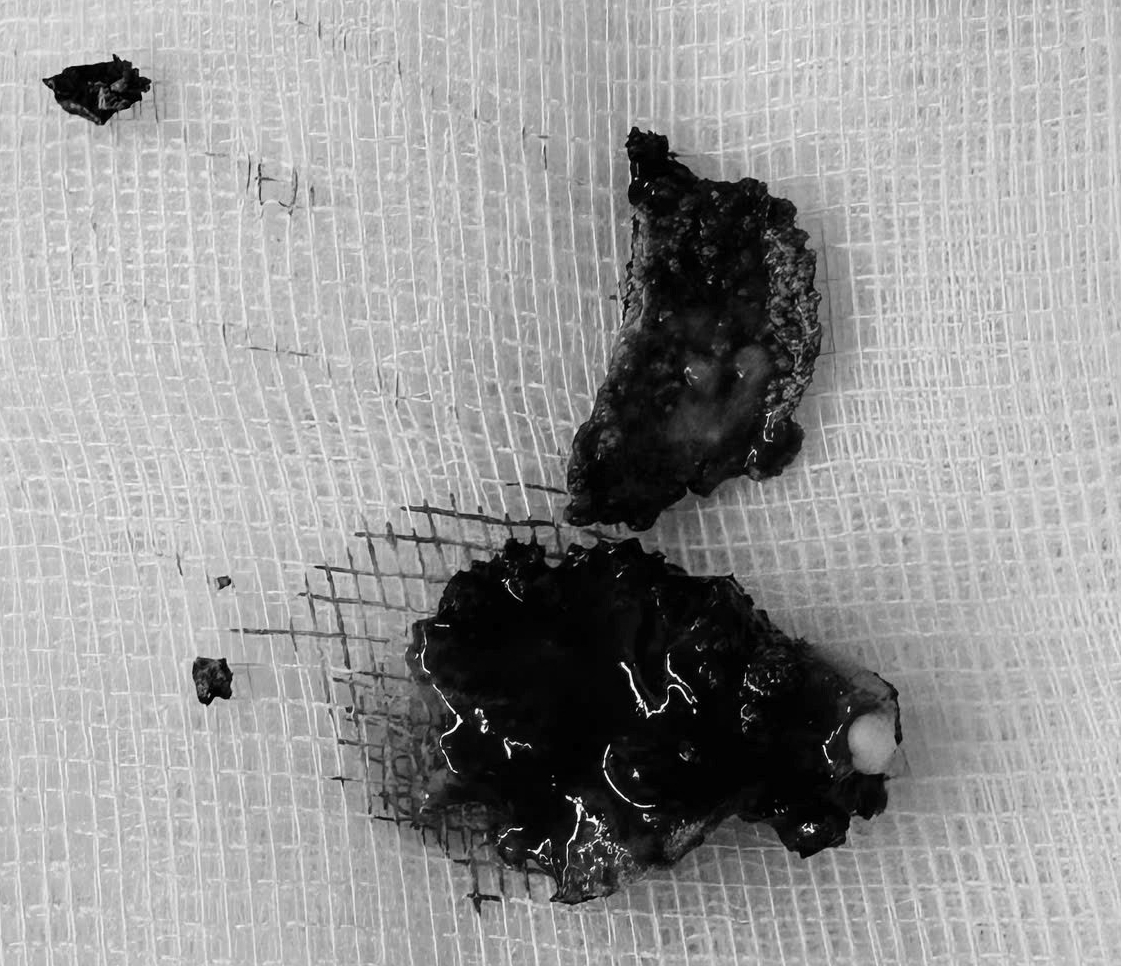 The doctor removed a calcified foreign object that had been in the ...