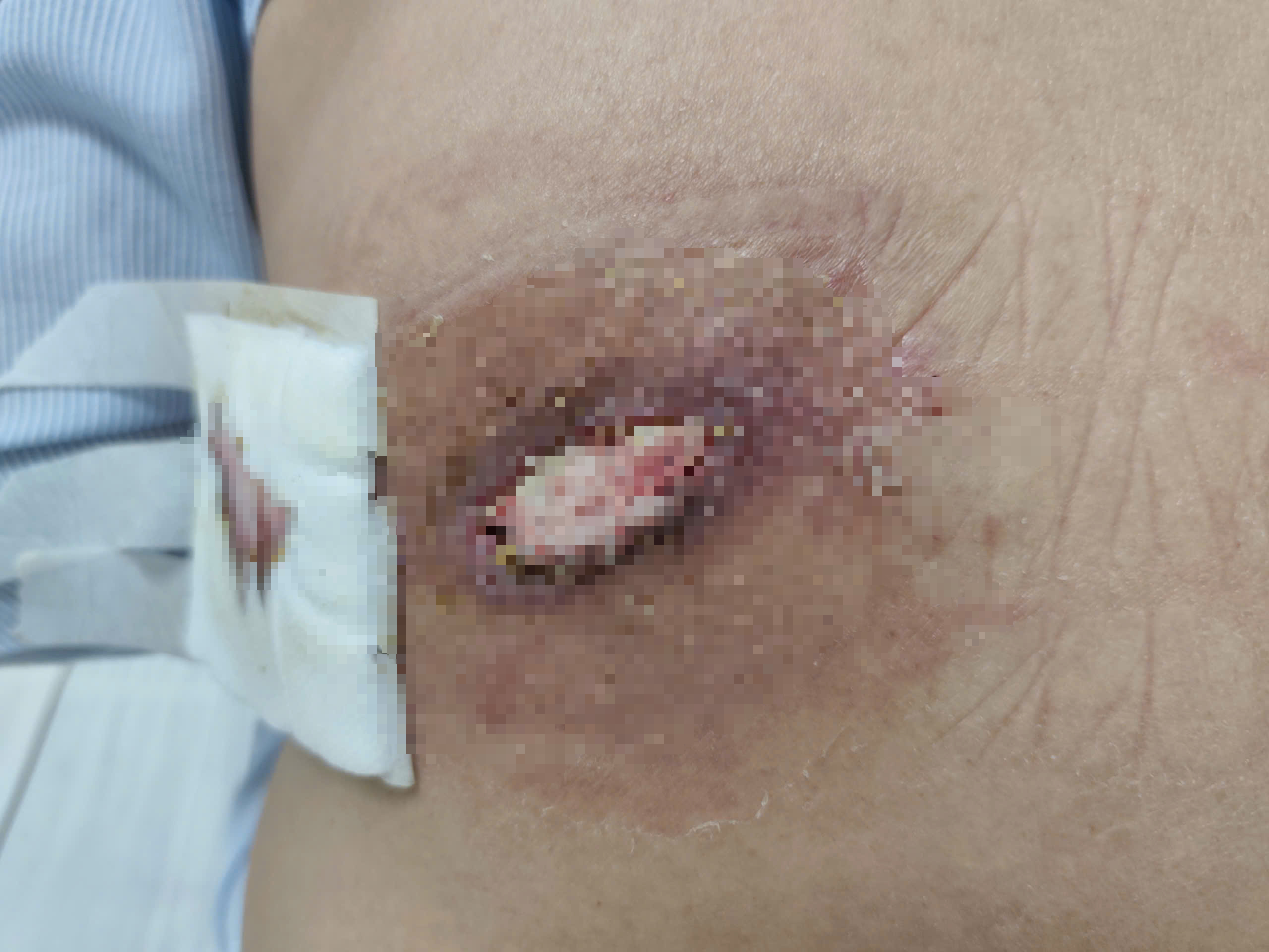 The woman suffered necrosis of the back after treating a boil using an ...