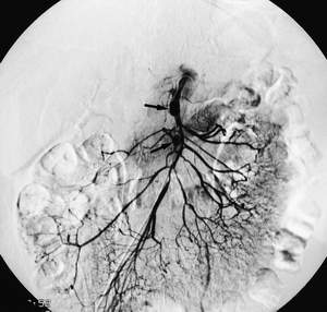 Hiểm nguy tiềm ẩn do viêm đa động mạch