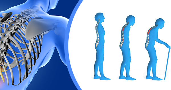 Loãng xương: 8 nhóm yếu tố nguy cơ bạn cần biết