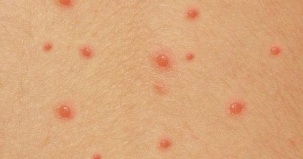 Bệnh u mềm lây có nguy hiểm không? Điều trị thế nào?