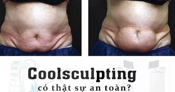 Điều trị Paradoxical Adipose Hyperplasia và loại bỏ phương pháp đông lạnh hủy mỡ Coolsculpting ...