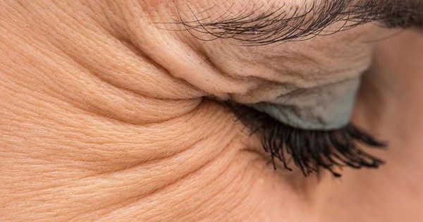 Làm gì để ngăn ngừa vết chân chim?