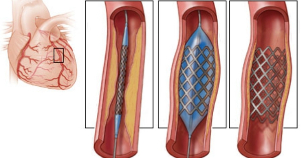 Sau khi đặt stent động mạch cần lưu ý gì?