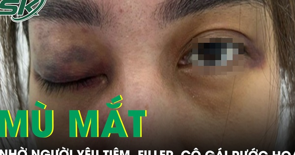 Mù mắt vì nhờ người yêu tiêm filler
