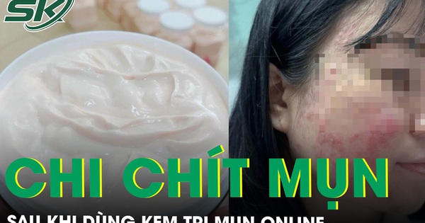 Mặt mụn chi chít, nguy cơ sẹo vĩnh viễn sau khi dùng kem trị mụn online