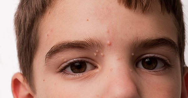 Bệnh u mềm lây rất dễ nhầm lẫn với bệnh ngoài da