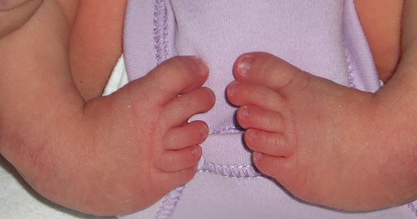 Làm sao để phục hồi chức năng bàn chân khoèo?