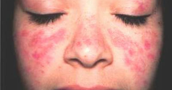 Liệu pháp mới chữa chứng luput ban đỏ
