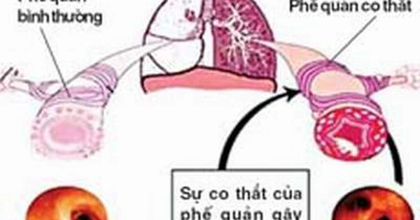 Ai dễ bị hen tim?