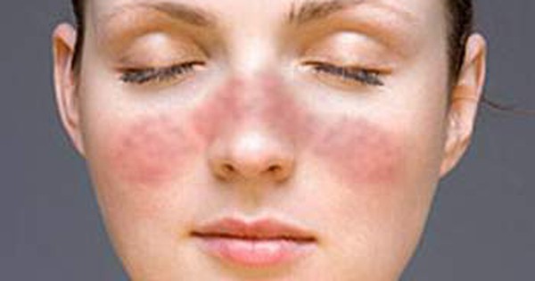 Bệnh Luput ban đỏ