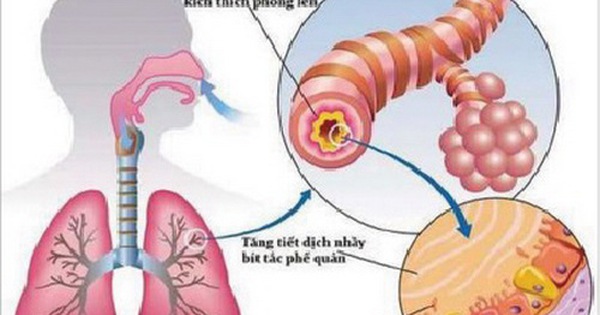 Mật ong - thuốc tốt trị viêm phế quản