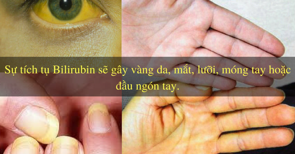 Cảnh giác với dấu hiệu vàng da