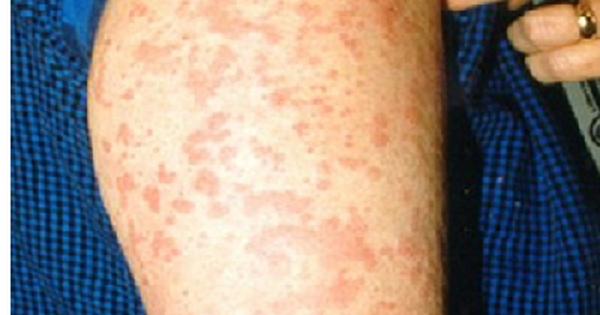 Thuốc trị bệnh Still ở người trưởng thành